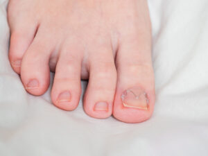 Ingrown, damaged nails – Enikam.com